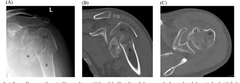 Figure 3 From Imaging Of Traumatic Shoulder Injuries Understanding