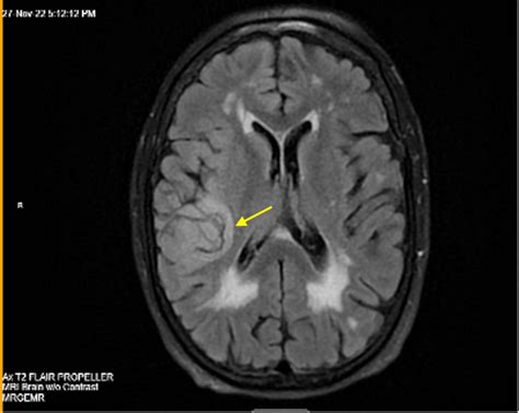 Rapid Onset Temporal Encephalitis With Negative Cerebrospinal Fluid