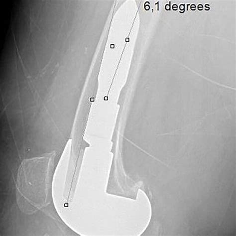 Measurement Of The Sagittal Femoral Component Alignment Using Sagittal Download Scientific