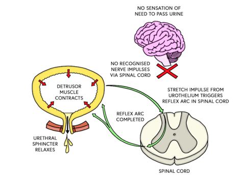 Functional Reflex Incontinence At Michelle Peckham Blog
