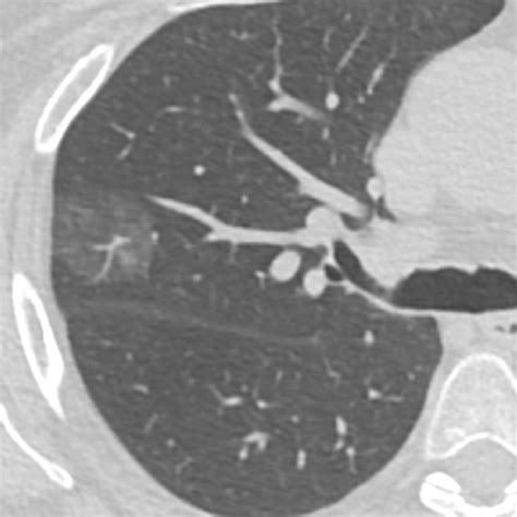 Pdf Subsolid Pulmonary Nodules Controversy And Perspective