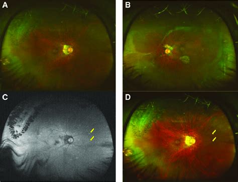 Fundus Photographs And Fundus Autofluorescence Faf Images Taken With Download Scientific