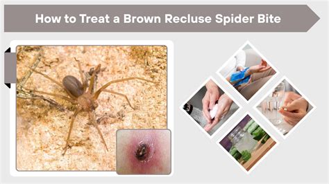 How To Treat A Brown Recluse Spider Bite Home Care And Medical Treatment