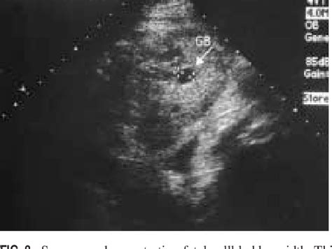 Figure 3 From The Fetal Gallbladder Semantic Scholar