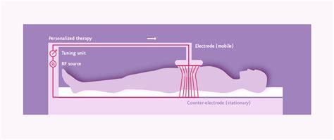 Why And How Hyperthermia Clinics International