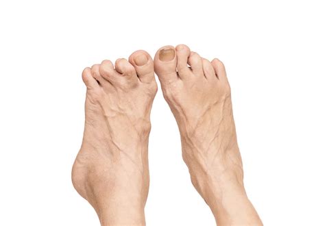 Rheumatoid Arthritis Feet