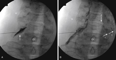 Transforaminal Epidural Steroid Injections And Selective Nerve Root
