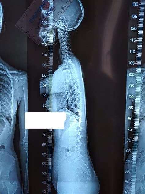 Dextrose Prolotherapy For Knee Osteoarthritis Sports Medicine Review