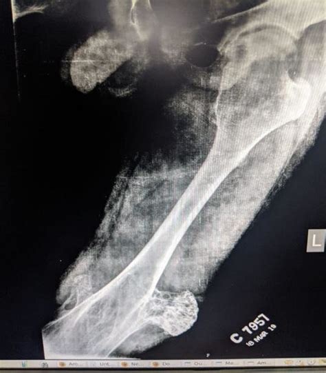 Left Distal Femur Proximal Tibia Fibula Showing Large Bony Lesions Of Download Scientific