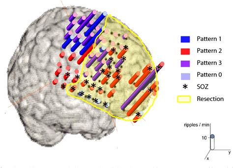 Figure 3 From Differentiation Of Specific Ripple Patterns Helps To