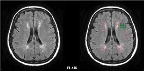 a descriptive example of semi automated lesion segmentation process on