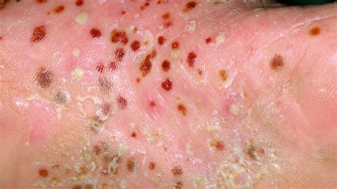 Generalised Pustular Psoriasis