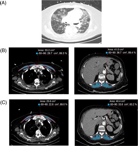 Representative Computed Tomography Ct Scans At Thoracic Level Used To Download Scientific