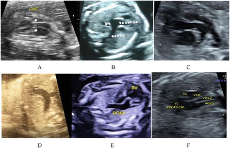 Fetal Echocardiogram Normal And Abnormal Intechopen