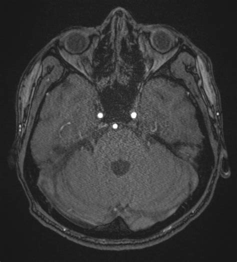 Basal Ganglia Subacute Infarct Radiopaedia 80201 93521 Axial Mra Nc