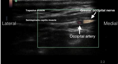 Scalp Block Technique Indications And Clinical Use The Anesthesia Guide