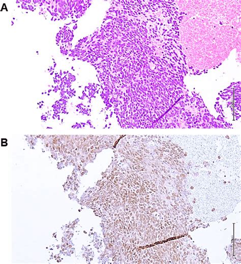 Mediastinal Lymph Node Resected During Bronchoscopy Hematoxylin And
