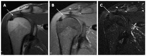 Supraspinatus Tear Mri