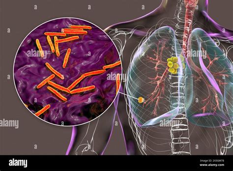 Illustration Of Primary Lung Tuberculosis Featuring The Ghon Complex And Mediastinal