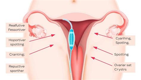 Iuds And Ovarian Cysts Whats The Link