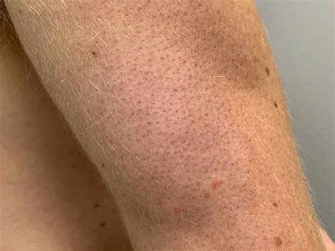 Keratosis Pilaris On Lower Arms