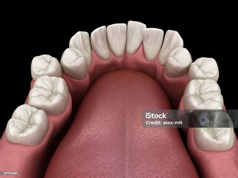 비정상적인 치아 위치 치열 교정 개념 의학적으로 정확한 치아 3d 일러스트레이션 기이함에 대한 스톡 사진 및 기타 이미지 기이함 디자인 디지털 생성 이미지 Istock