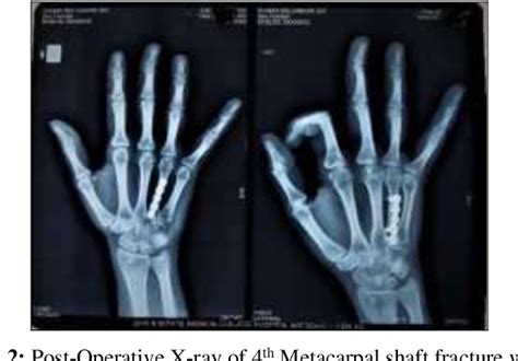 Figure 1 From Functional Outcome Of Osteosynthesis Of Closed Metacarpal Fractures With Mini