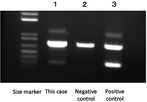 Analyses Of Myd88l265p Mutation Using Allele‐specific Polymerase Chain Download Scientific