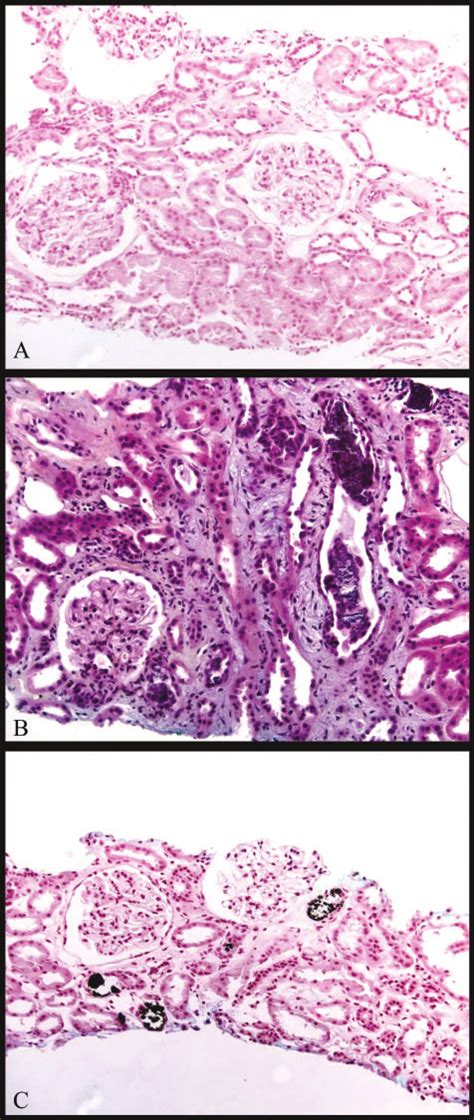 Histologic Findings In A Patient With Acute Phosphate Nephropathy A Download Scientific