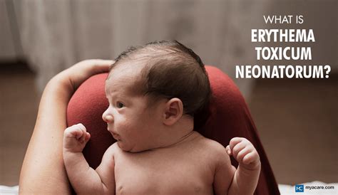 Erythema Toxicum Neonatorum Etn A Common Newborn Rash Mya Care
