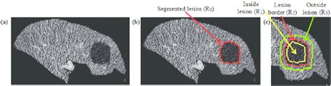 Liver Lesion Rois A Segmented Liver B Segmented Lesion R0 C