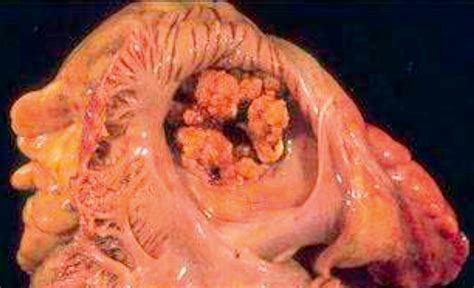 Endocarditis And Other Intravascular Infections Clinical Tree