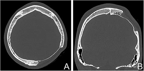 Frontiers A Large Skull Defect Due To Gorham Stout Disease Case