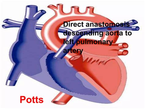Tricuspid Atresia In Pediatrics Pptx Heart And Cardiovascular