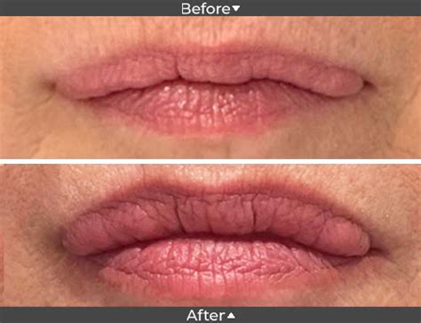 Botox Before And After Pictures In Los Angeles Assil Gaur Eye Institute