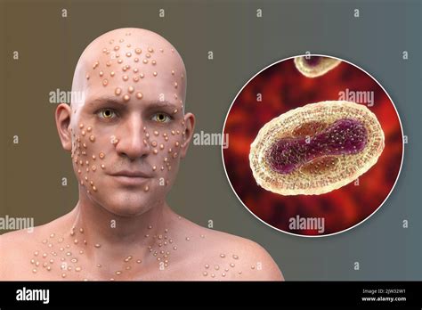 Patient With Smallpox Variola And Close Up Of A Smallpox Virus Illustration Smallpox Is A