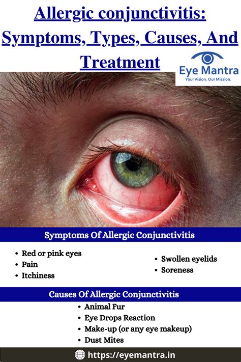 Allergic Conjunctivitis Symptoms Types Causes And Treatment Artofit