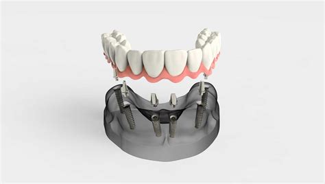 Tipos De Prótesis Dentales Fijas Conde Duque