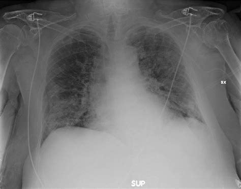 Small Consolidation And Interstitial Pattern Download Scientific Diagram