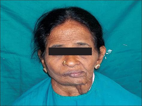 Prosthetic Management Of Hemimandibulectomy Patient With Guiding Plane And Twin Occlusion