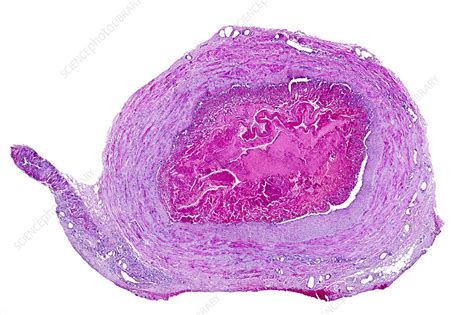 Thrombus Light Micrograph Stock Image C0494138 Science Photo