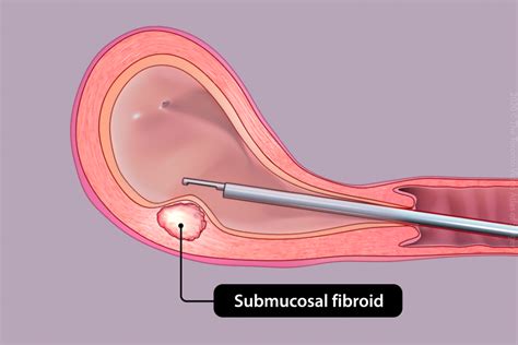 Patient Education Hysteroscopy Procedure The Toronto Video Atlas Of