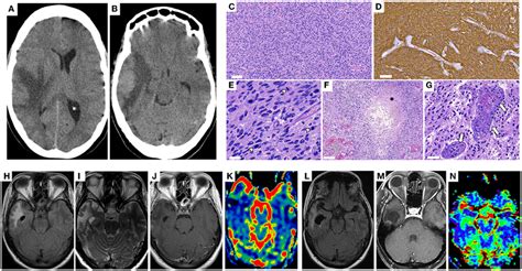 A B Non Contrast Computed Tomography Imaging In April 2016 Before