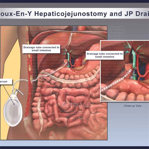 Medical Legal Exhibits Legal Animations And Trial Graphics Tria