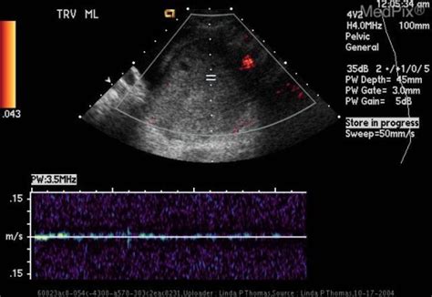 Ultrasound Pelvic Wikem