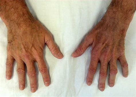 Ulnar Nerve In Hand Muscles