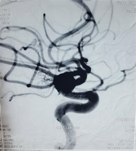 Coiled Acoa Aneurysm In 50 Neuro Angiography Suite
