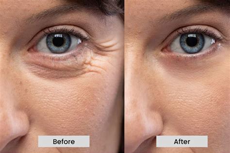 Skin And Endocrine Results Endoderma Success