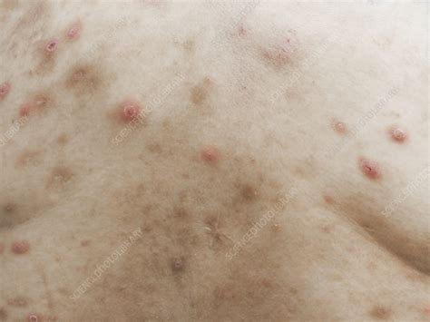 Crusted Scabies Infection Stock Image C0599442 Science Photo Library