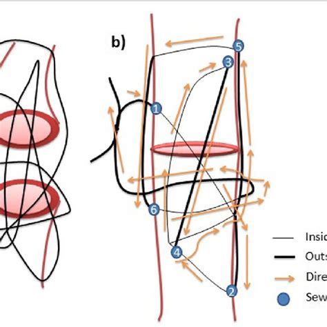 3 loop pulley suture the sketch shows how to perform the 3 loop pulley